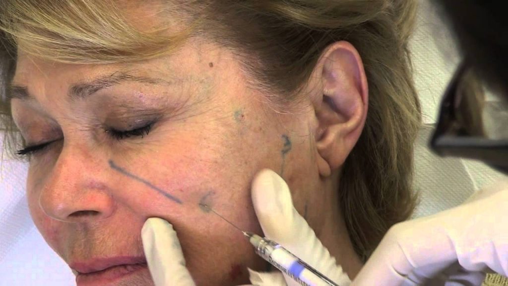 Comment éliminer les rides du sillon nasogénien