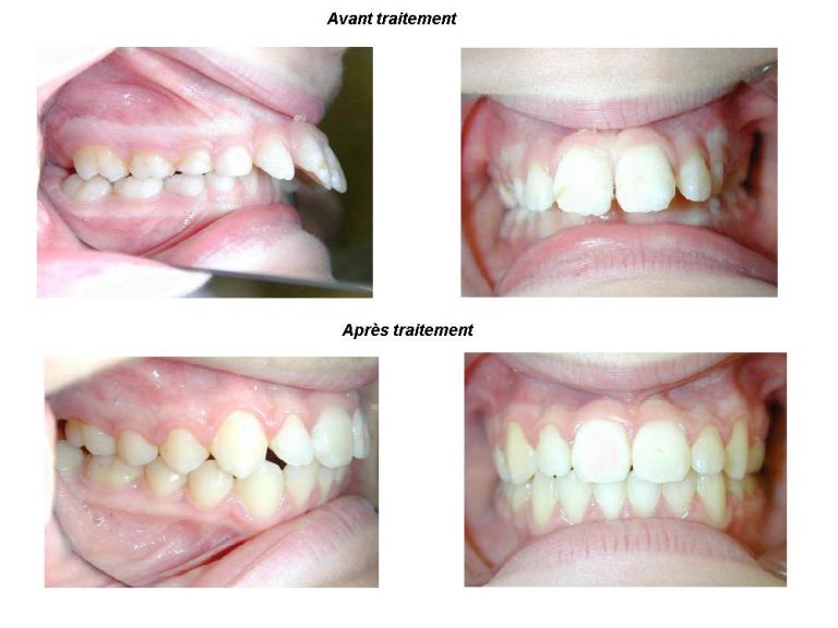 Qu'est-ce que le Prognathisme et comment le traiter