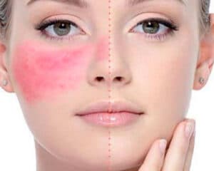 Traitement laser coloration rouge de la peau rosacée couperose érythrose