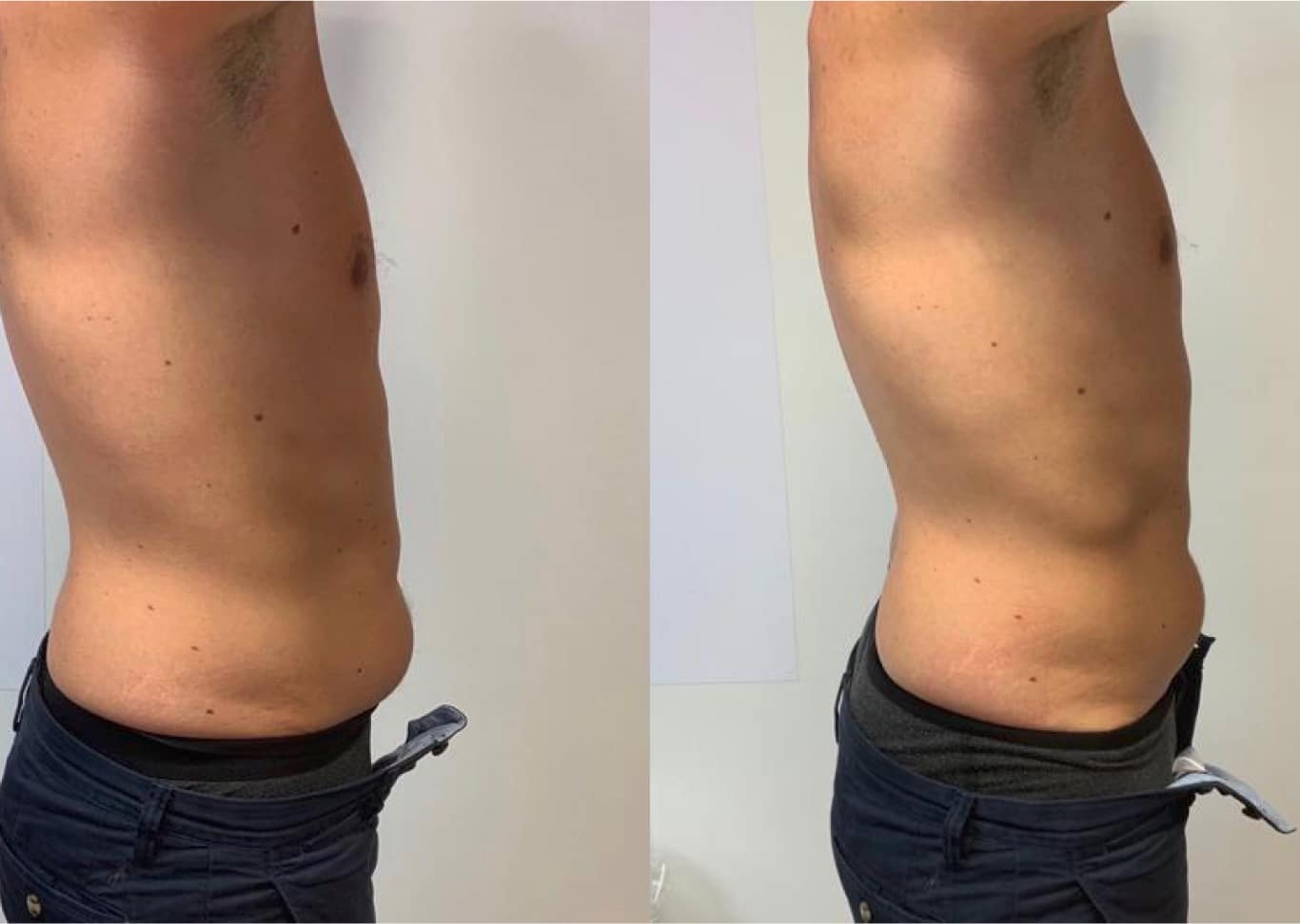 ReBorn mincir et détruire la graisse du corps sans chirurgie