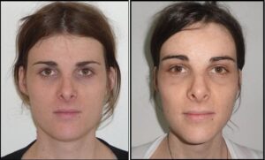 Féminisation arcade sourcilière : un regard doux et plus féminin